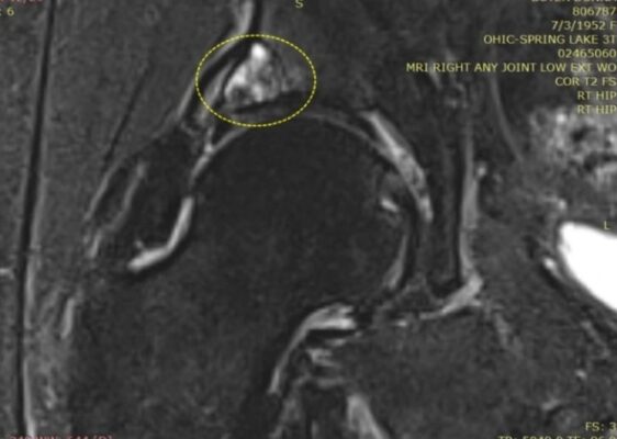 Is A Cyst On The Hip Serious? Understanding Acetabular Cysts