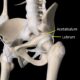 Is A Cyst On The Hip Serious? Understanding Acetabular Cysts