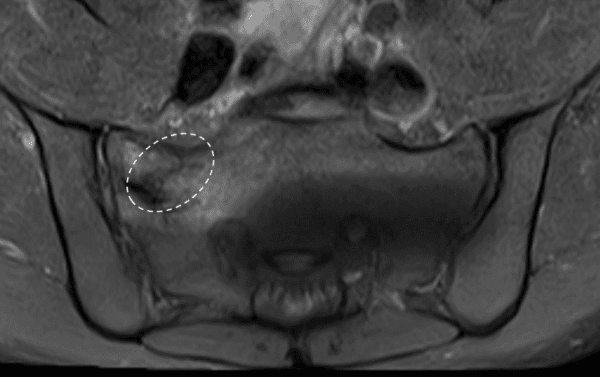 What Is Osteitis Pubis? Key Facts About This Pelvic Condition