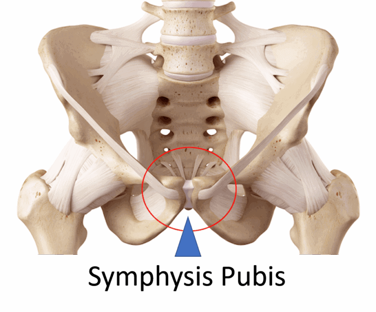 What Is Osteitis Pubis? Key Facts About This Pelvic Condition